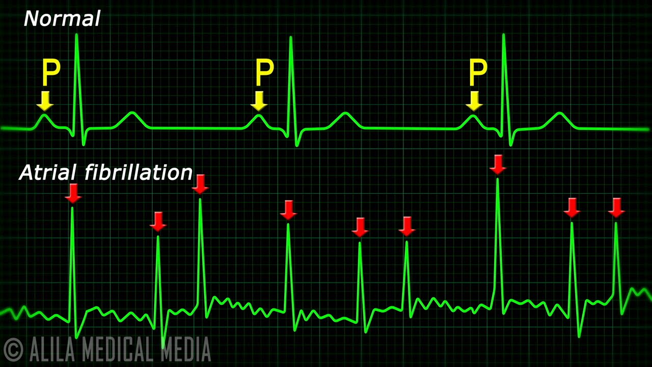 心房顫動動畫，心電圖，中風。 (Atrial Fibrillation Anatomy, ECG and Stroke, Animation ...